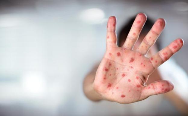 Pediatras Recomiendan Vacunar De Sarampión A Los Bebés Menores De 1 Año
